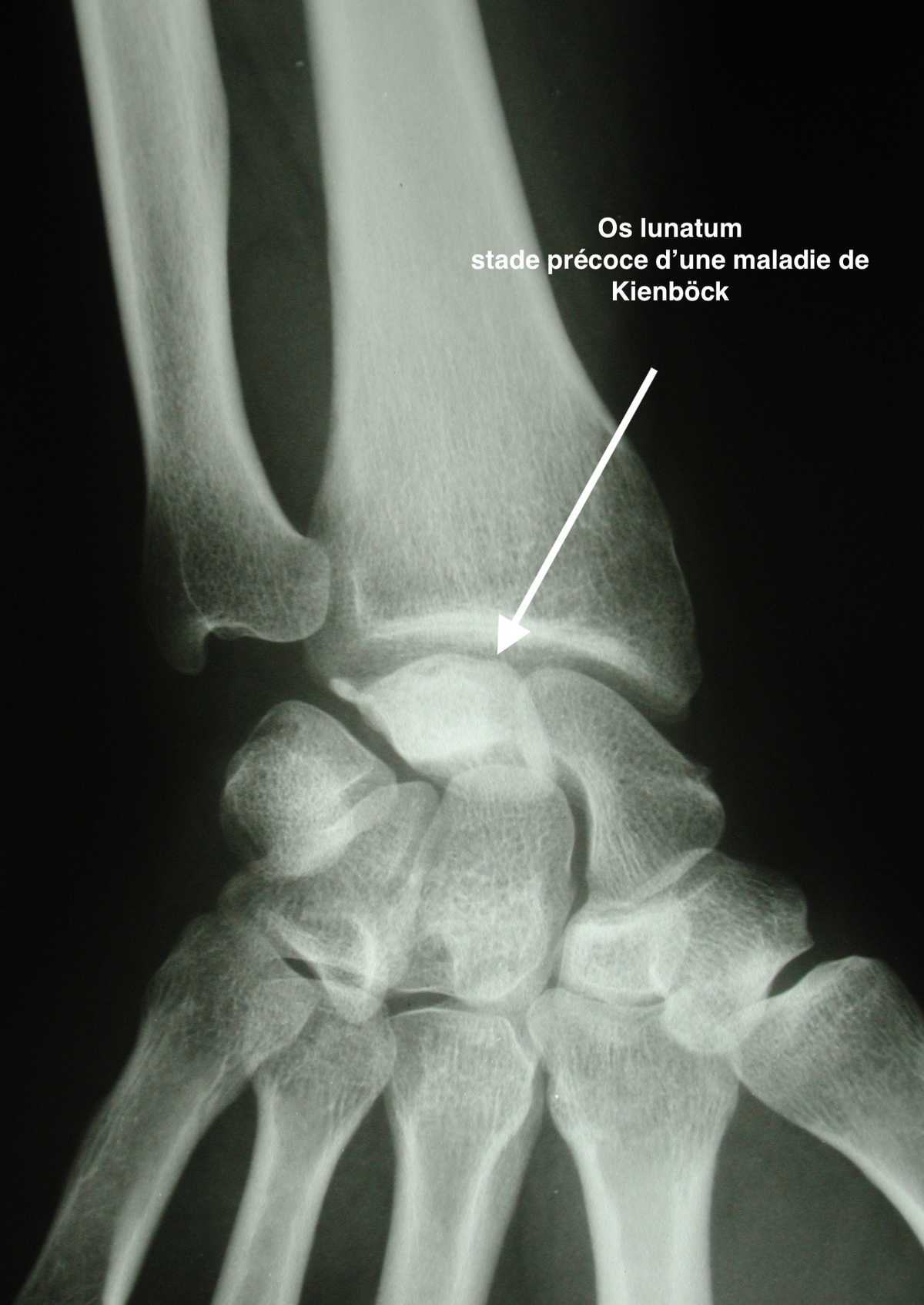 Maladie de Kienböck : Diagnostic et chirurgie - Dr Philippe Roure