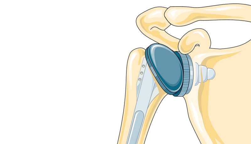 Chirurgien de l'épaule à Paris - Dr Philippe Roure