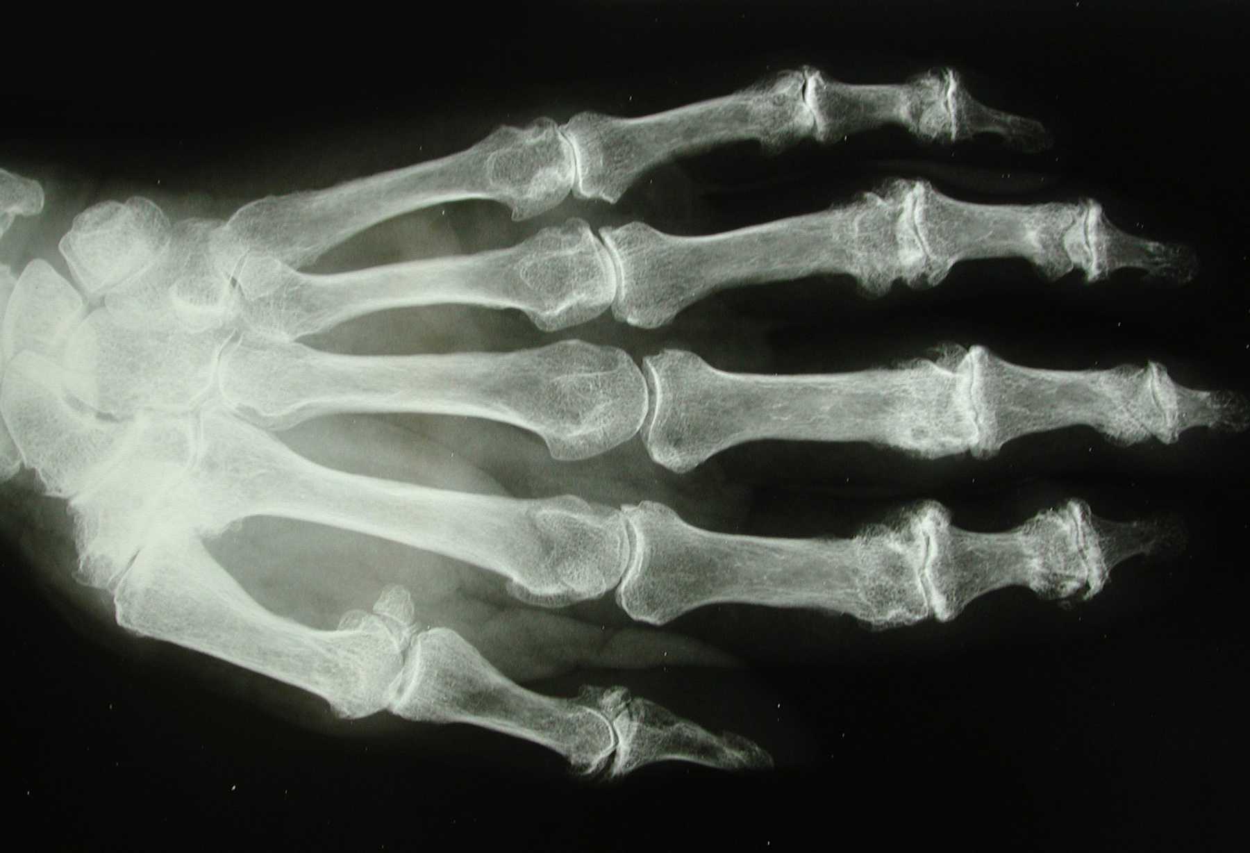 Arthrose des doigts : Diagnostic et traitements - Dr Roure