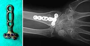 Fracture du poignet : diagnostic et traitement à Paris - Dr Roure